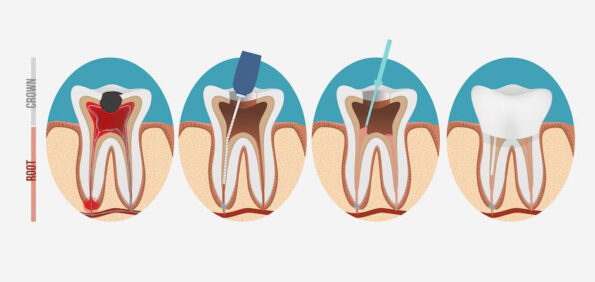 Three stages of root canal treatment explained.| Dr. Brett Langston